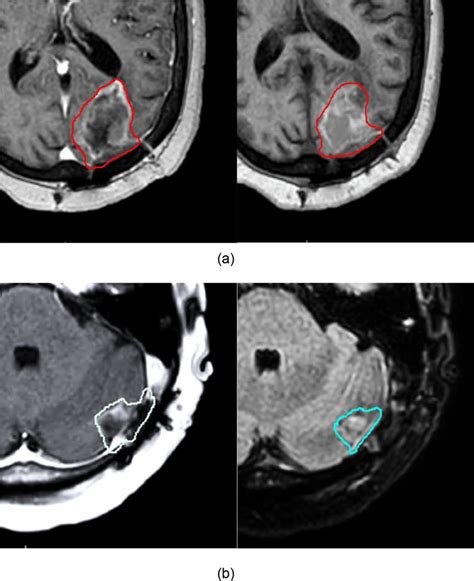 Case Examples Of Cavity Dynamics And Ctv Contouring Variability A Case