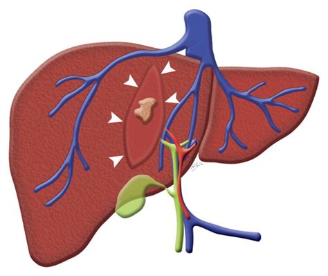 Vascular And Biliary Variants In The Liver Implications For Liver