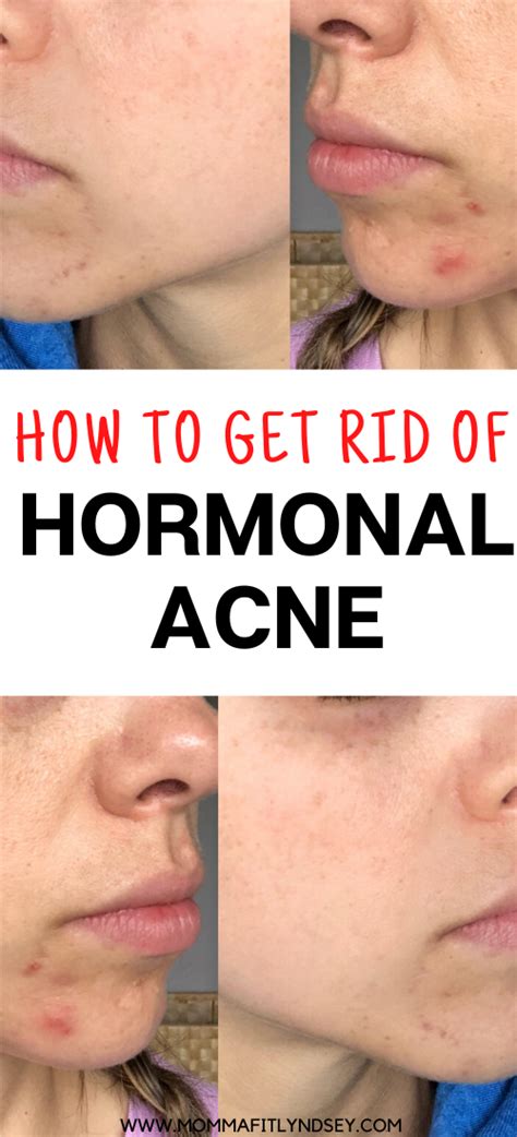 Cystic Acne Chin Treatment