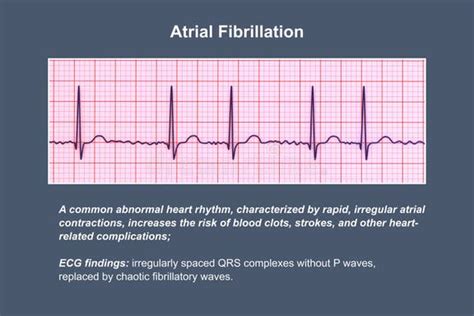Ecg In Atrial Fibrillation 3d Illustration Stock Illustration