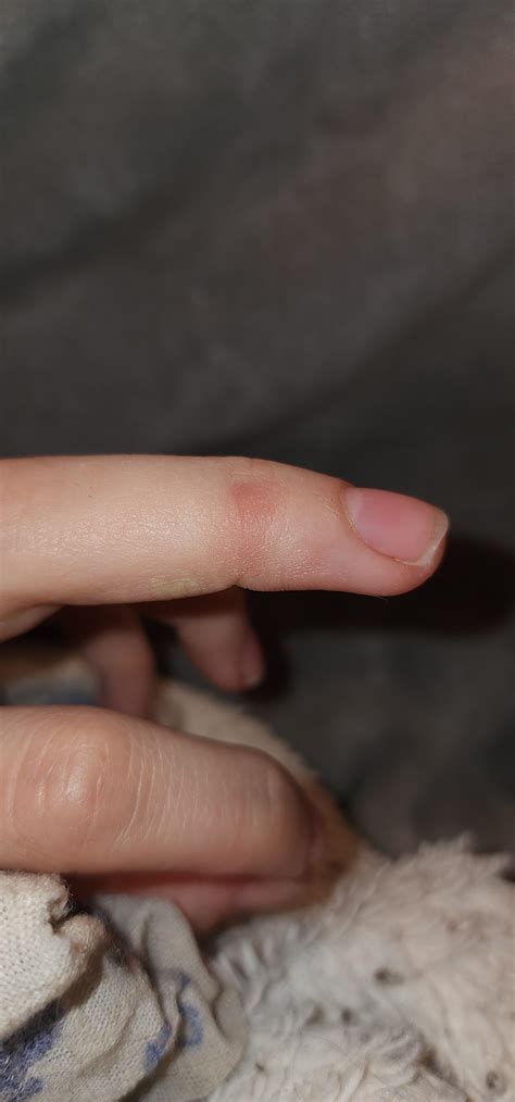 Hard Red Bump On Knuckle Sometimes Swells Up More Xray Showed Nothing