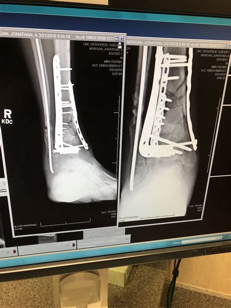 Broken Tib Fib Recovery Moto Related Motocross Forums Message Boards Vital MX