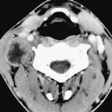 Contrast Enhanced Ct Scan Of Neck Shows Peripherally Enhancing Mass