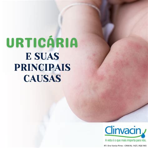 Urticária E Suas Principais Causas