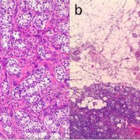 Histology Of Bilateral Orchiectomy Specimens A Sertoli Cell Nodule