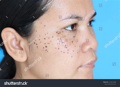 Laser Treatment For Dark Spots
