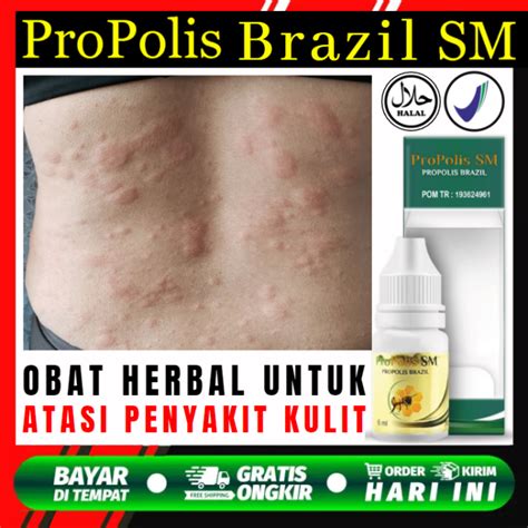 Obat Alergi Dingin Kulit Gatal Bentol Kaligata Gatal Seluruh Badan Gatal Luar Dalam Budug Cenang