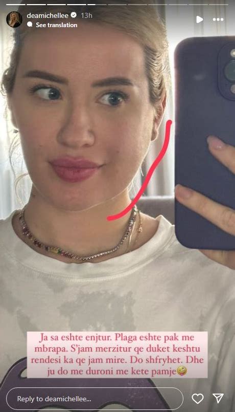 She Underwent A Surgical Intervention Dea Mishel Shows The Condition