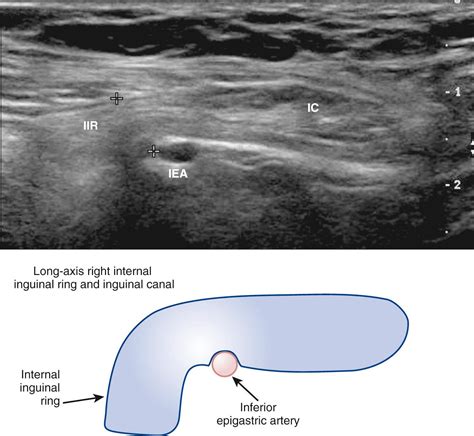 Dynamic Ultrasound Of Hernias Of The Groin And Anterior Abdominal Wall