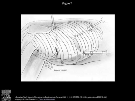 lung segmentectomy for patients with peripheral t1 lesions ppt download