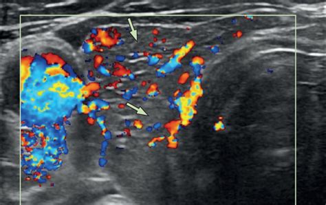 Normal Thyroid Ultrasound