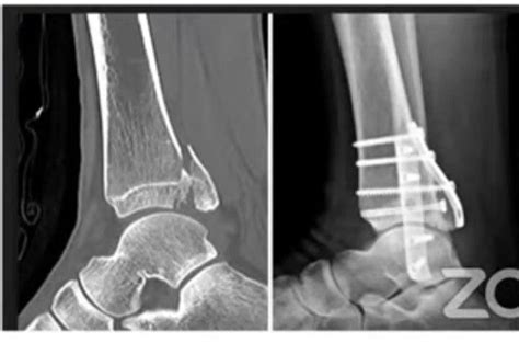 Ankle Fracture Ankle Fracture Management Muscle Testing