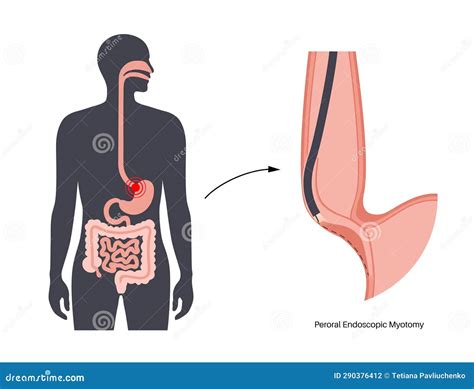 POEM Medical Poster Stock Vector Illustration Of Disorder 290376412