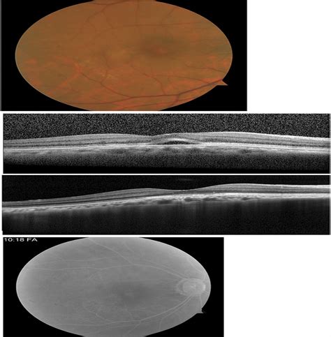 Dome Shaped Maculopathy Enhanced Visualization With Radial Retinal Cases And Brief Reports