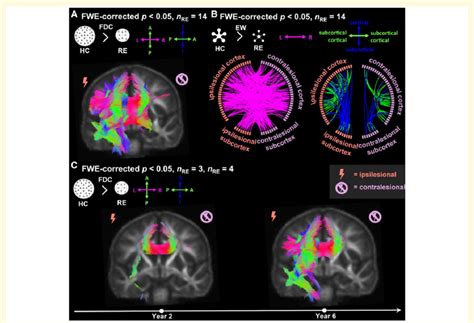 Group Wise Comparison Between Individuals With Rasmussens Encephalitis