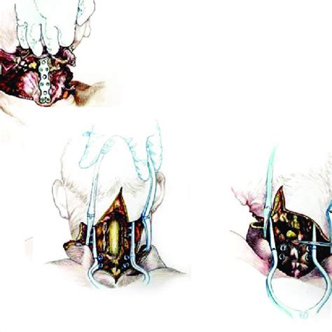 Xiaoping Ren Professor Doctor Of Medicine Orthopedics