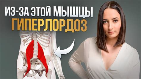ГИПЕРЛОРДОЗ вываленный низ живота боль в пояснице и всё из за ЭТОЙ