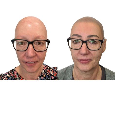 Smp For Alopecia Legends Clinic