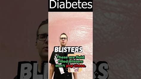 Blister On Foot Toe Or Between Toes Diabetic Skin Symptoms