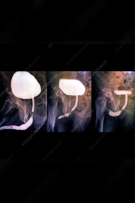 Micturating Cystourethrogram Mcug Fluoroscopic Procedure Xray Cystitis Urinary