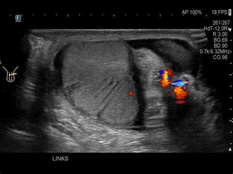 Torsio Testis Ultrasound Cases