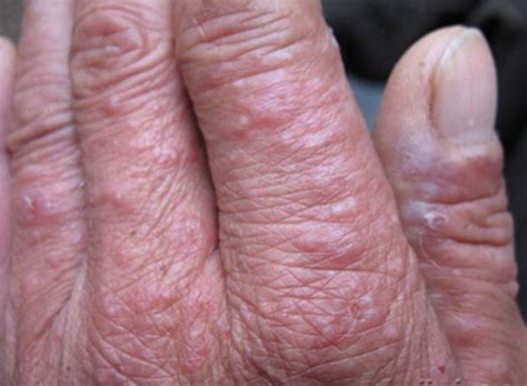 大人湿疹症状图片有来医生