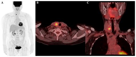 A Machine Learning Based Radiomics Model For The Differential Diagnosis Of Benign And Malignant