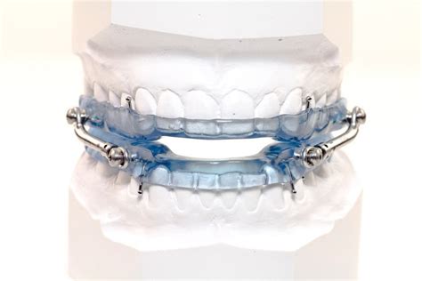 Oral Appliance Therapy Sleep Insights