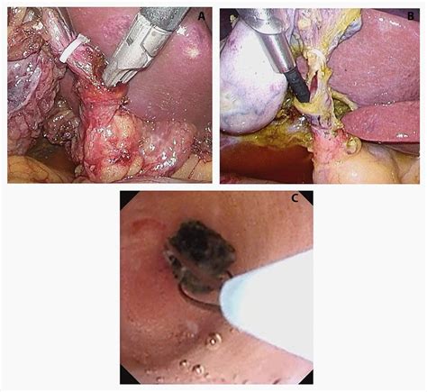 Surgical Procedure Of Transcystic Intraoperative Cholangioscopy A The