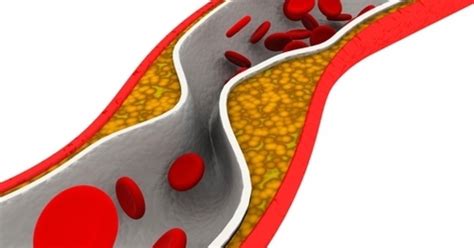 Colesterol Hdl Bajo Causas Cómo Aumentarlo Y Riesgos Para La Salud