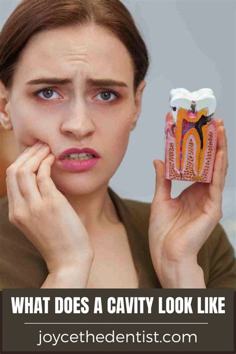 What Does A Cavity Look Like Characteristics Of A Cavity Artofit