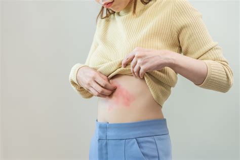 Shingles Not Just A Concern For The Elderly Rpa