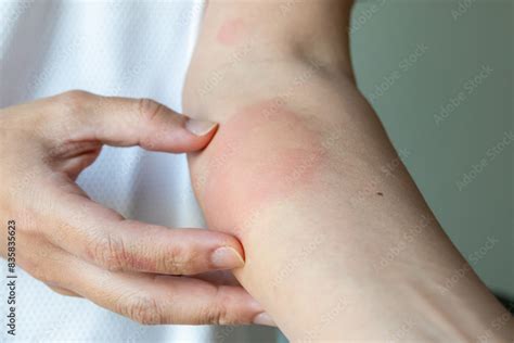 Young Asian Man Itching And Scratching On Arm From Allergic Itchy Dry