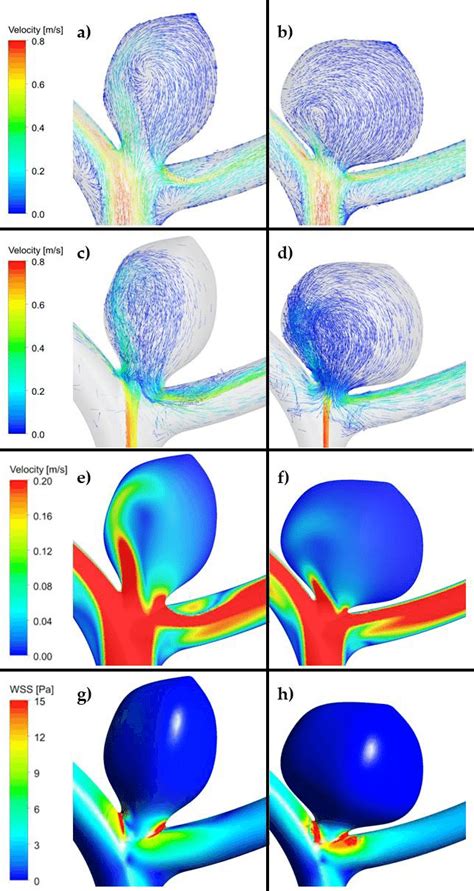 Aceg Example Of Reference Aneurysm Model Unruptured Group Download Scientific Diagram