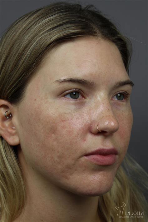 StarWalker Laser Before After Gallery Patient 11