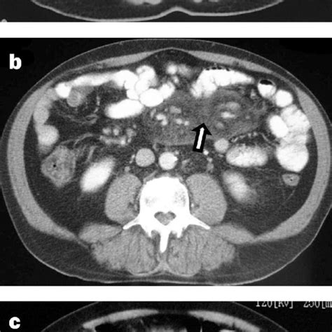 Ct Revealed A Mesenteric Mass Secondary To Mesenteric Panniculitis