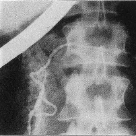 Normal Pancreatogram Note Side Branchesfilled To Second Generation
