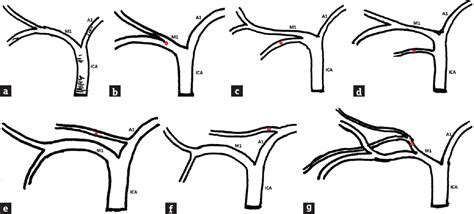 Twin Middle Cerebral Artery With Aneurysm A Variant Of Early Bifurcation Or A Discrete Entity