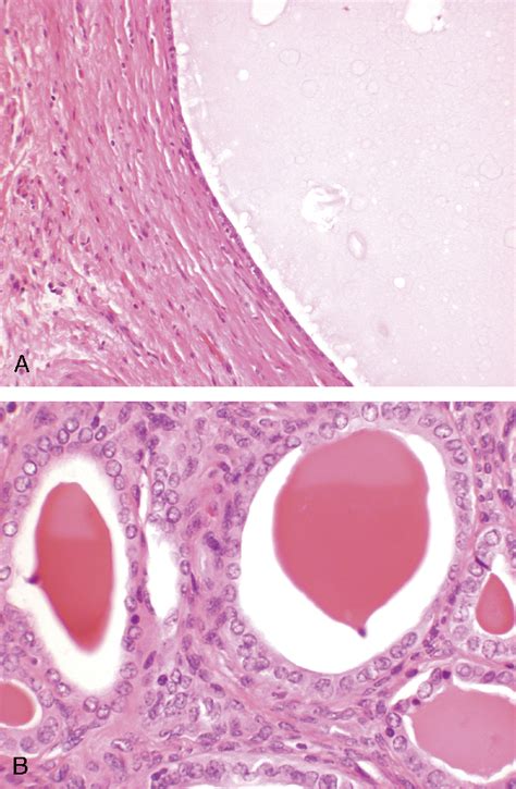 Genital Cyst In Women