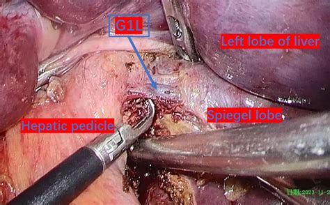Laparoscopic Left Approach Resection Of The Caudate Lobe