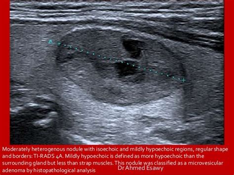 Tirads Thyroid Nodule Imaging Reporting And Data System Dr Ahmed E