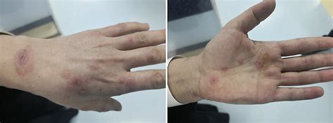 The Dorsum And Palmar Surface Of The Left Hand Showed Polymorphous Download Scientific Diagram