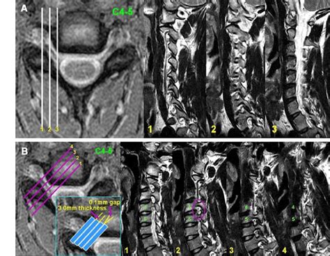Cervical Spine Mri Comparison Cervical Spine Mri Comparison