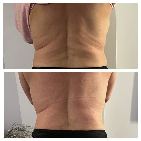 Body Contouring Miami Free Consultation Before And After — Myemshealth