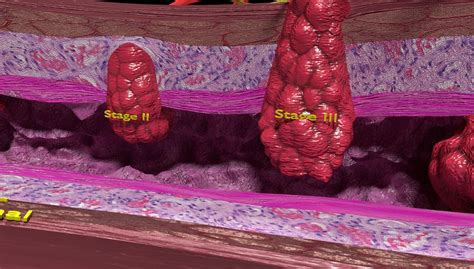 Artstation Colon Cancer Staging Labelled Resources