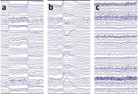 Examples Of Artifacts A Eye Movement B Blinkingc Download