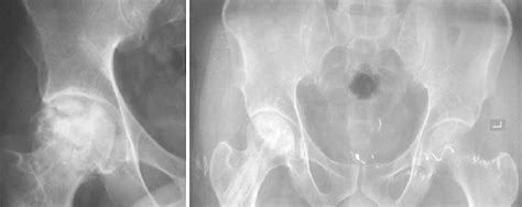 A X Ray R Hip Joint Anteroposterior View Showing Advanced Stage