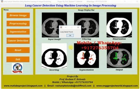 Lung Cancer Detection Using Machine Learning Technique Matlab Project