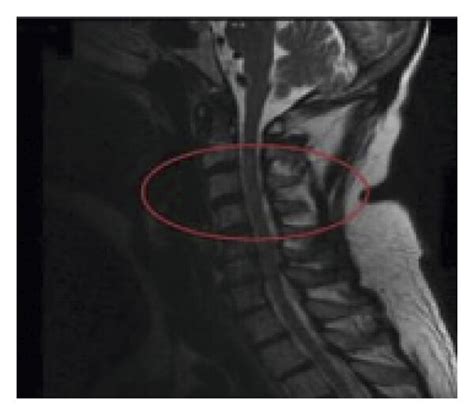 Ad Mri Of The Cervical Spine With And Without Gadolinium