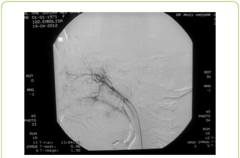 B Complete Occlusion Of The Tumour Arterial Supply After Embolization Download Scientific
